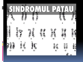 Sindromul patau | PPTX