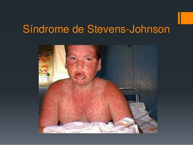 Sind stevens johnson