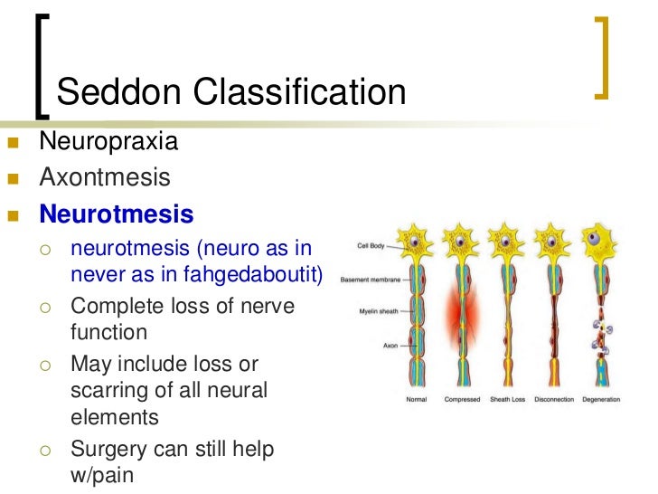 Carpal Tunnel Syndrome
