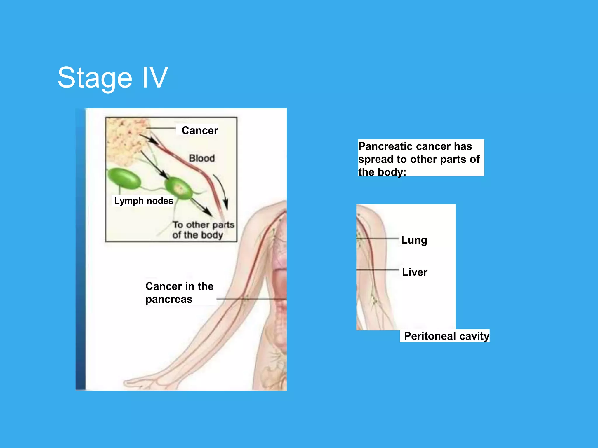 Singh Akash 413 treatment of pancreatic cancer.pptx