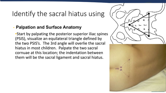 Single-Injection-Caudal-Blocks-for-Pediatric-Anesthesia-7_17.pptx ...