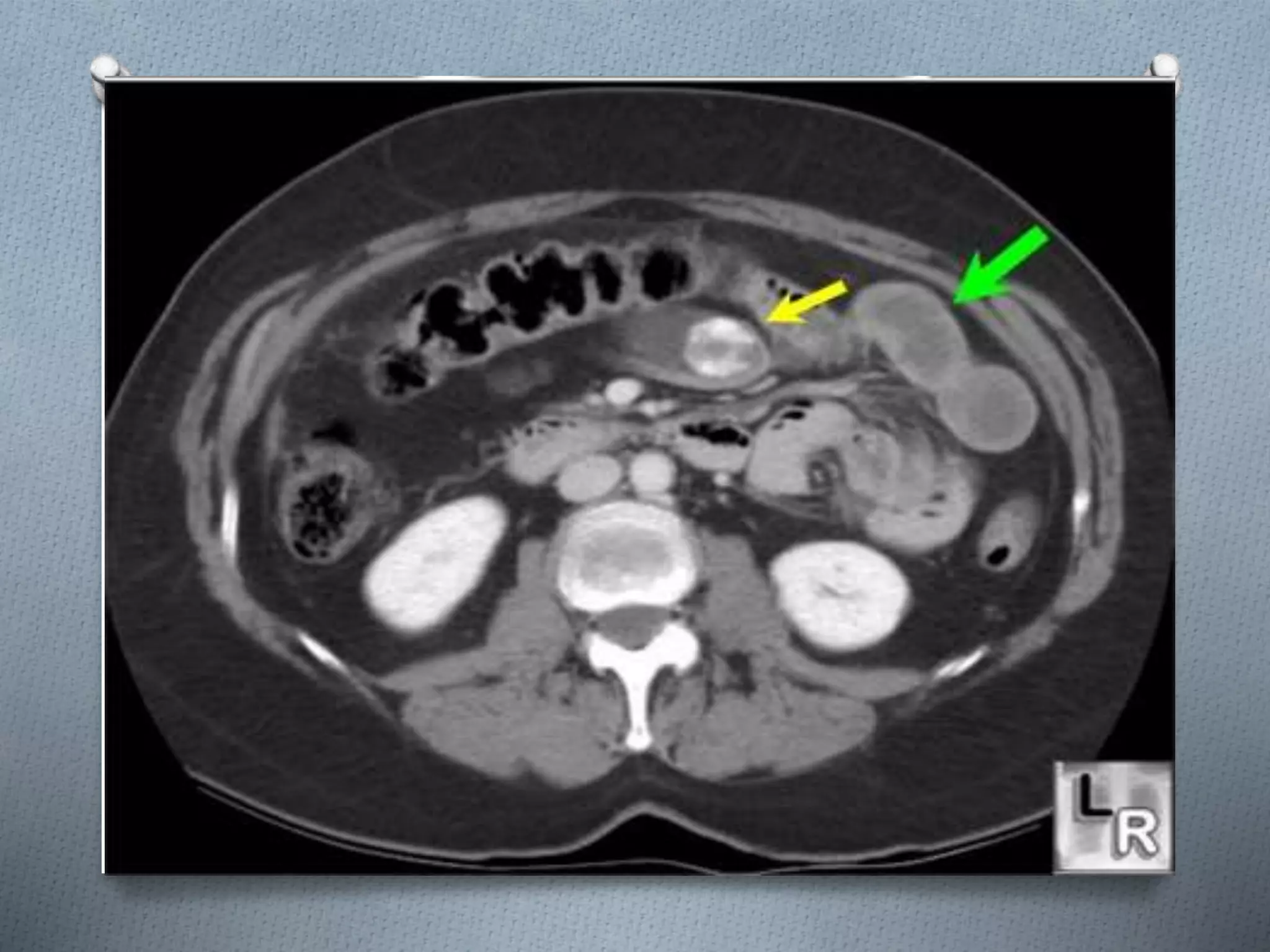 Single-stage laparoscopic management for concomitant gallstones and ...