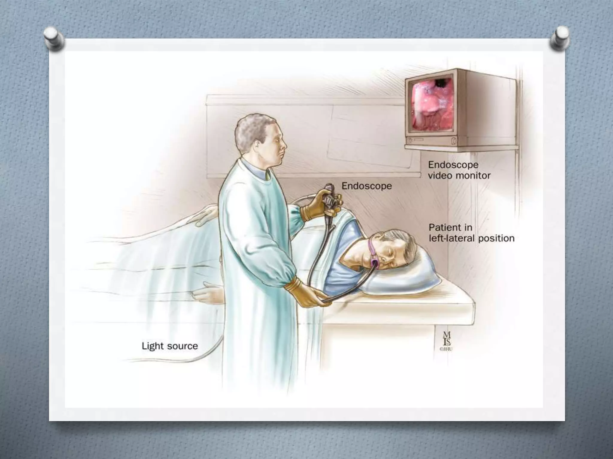 Single-stage laparoscopic management for concomitant gallstones and ...