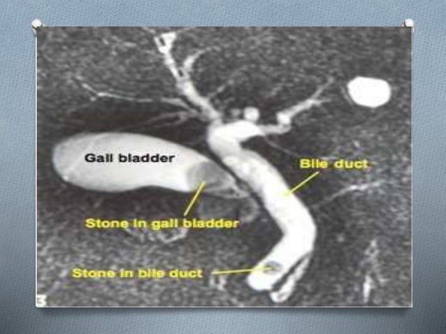 Single-stage laparoscopic management for concomitant gallstones and ...
