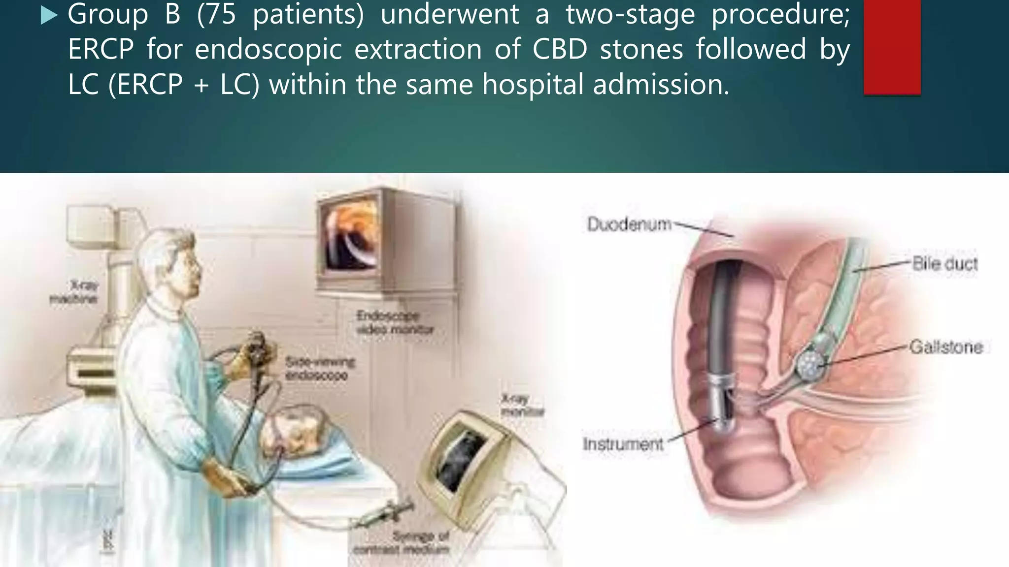 Single stage laparoscopic management for concomitant gallstones and common bile duct stones ...