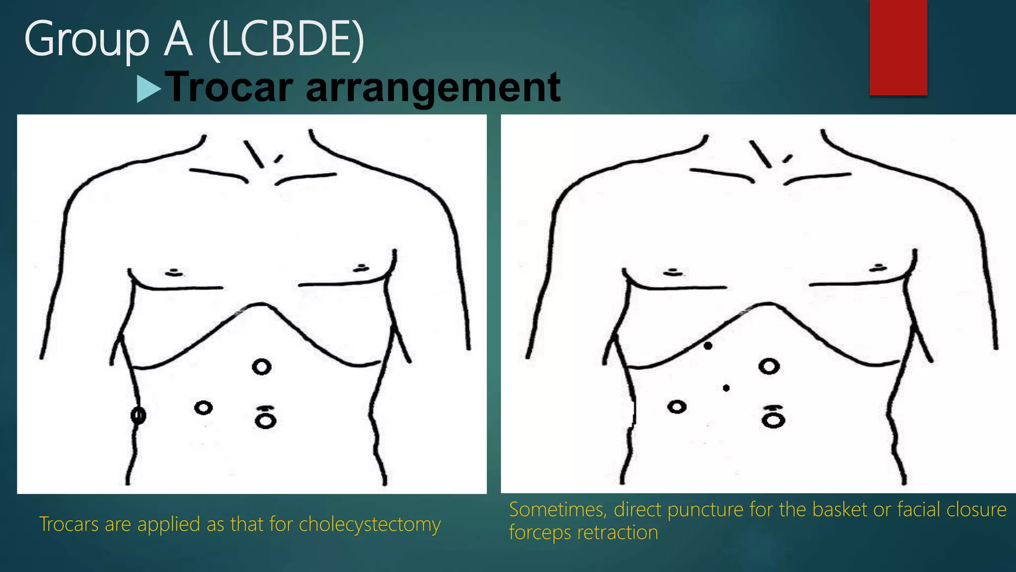 Single stage laparoscopic management for concomitant gallstones and ...