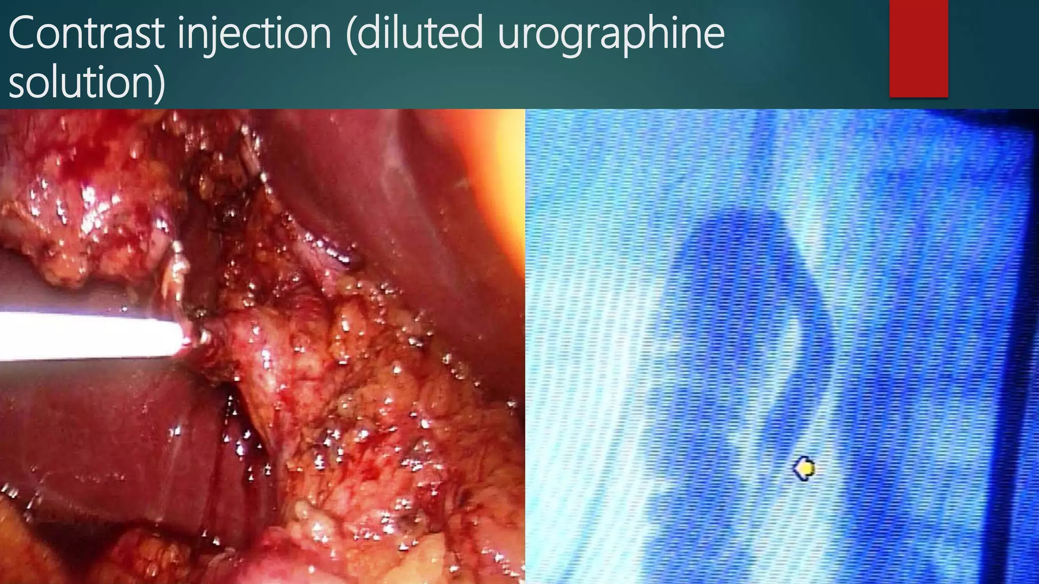 Single stage laparoscopic management for concomitant gallstones and ...