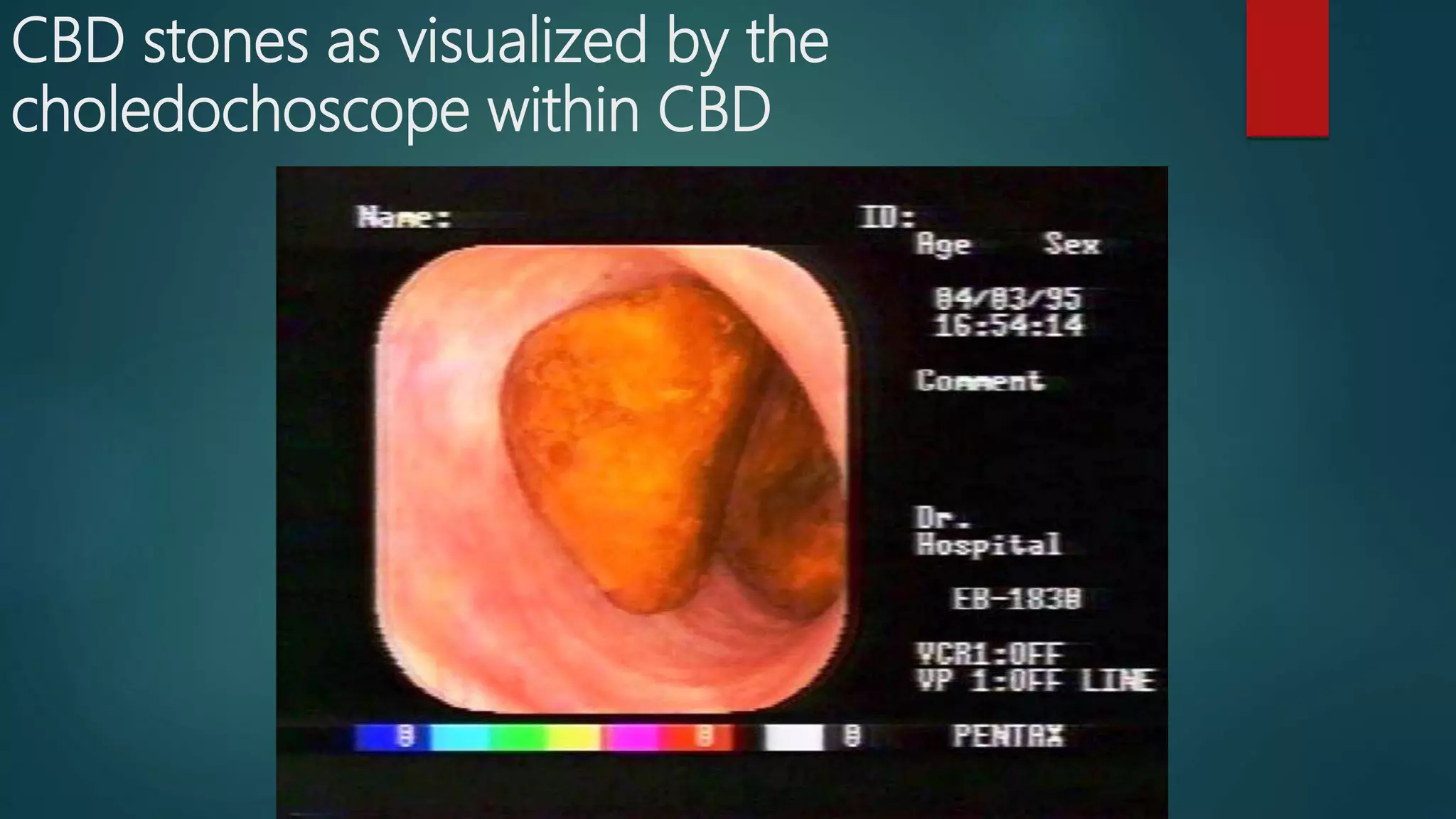 Single stage laparoscopic management for concomitant gallstones and ...