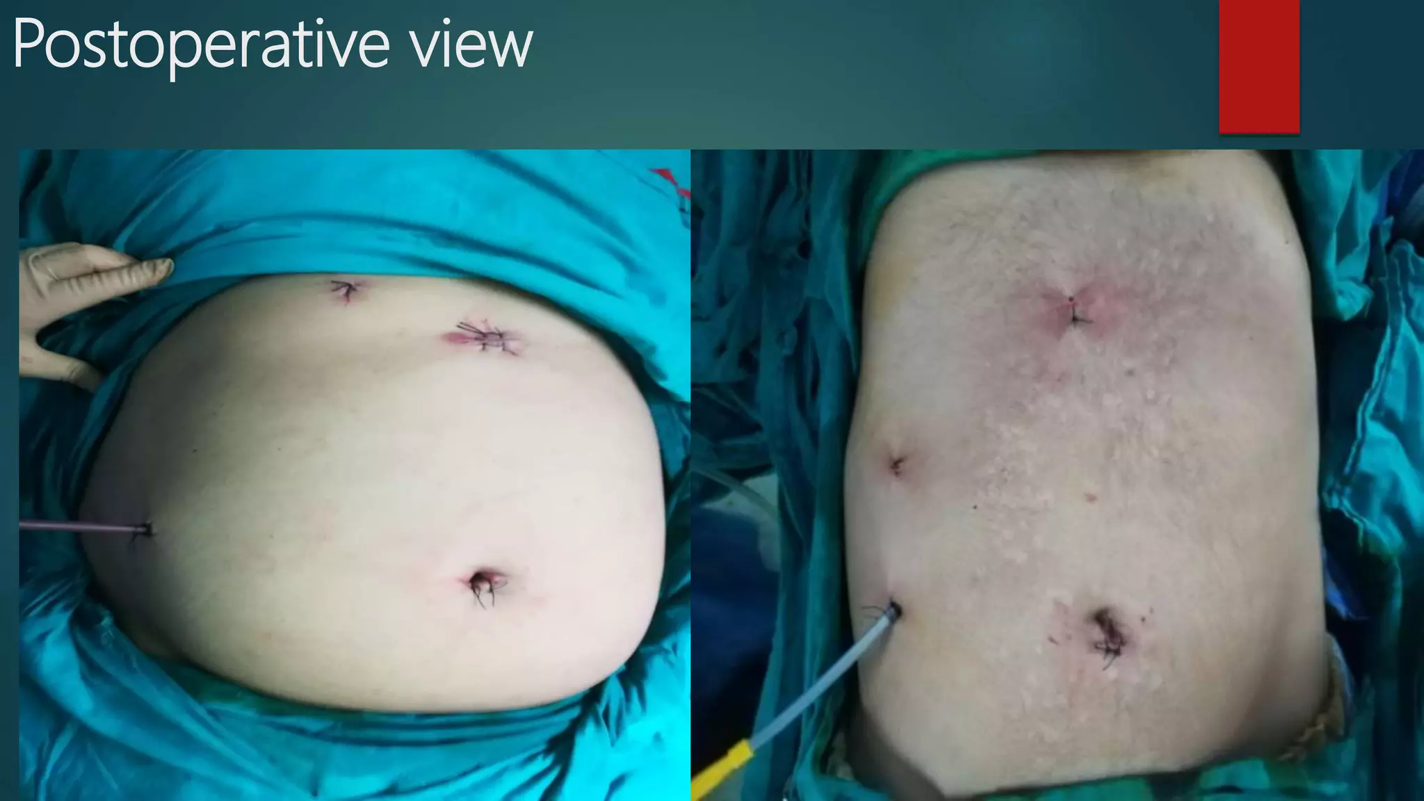 Single stage laparoscopic management for concomitant gallstones and ...