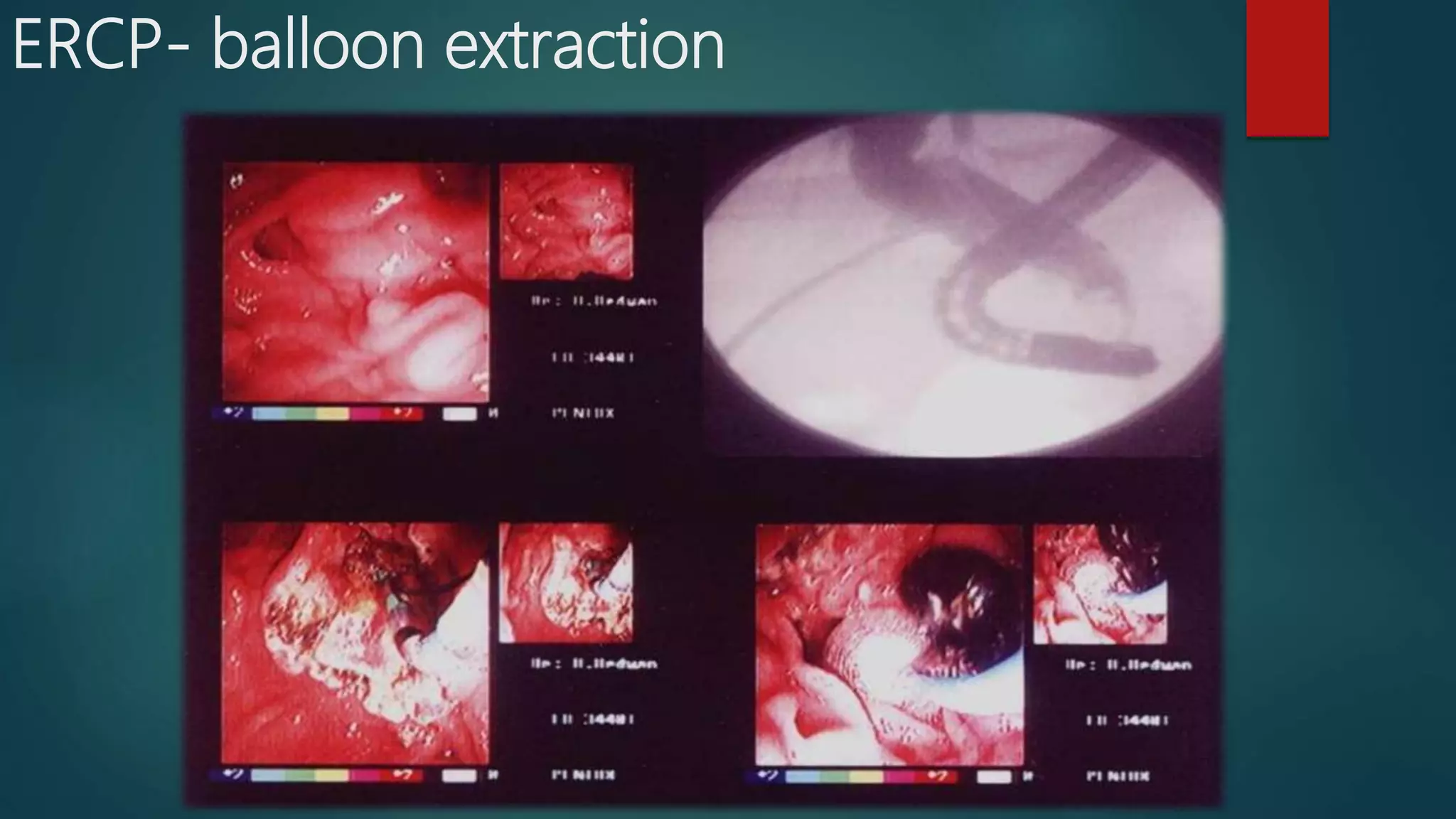 Single stage laparoscopic management for concomitant gallstones and ...