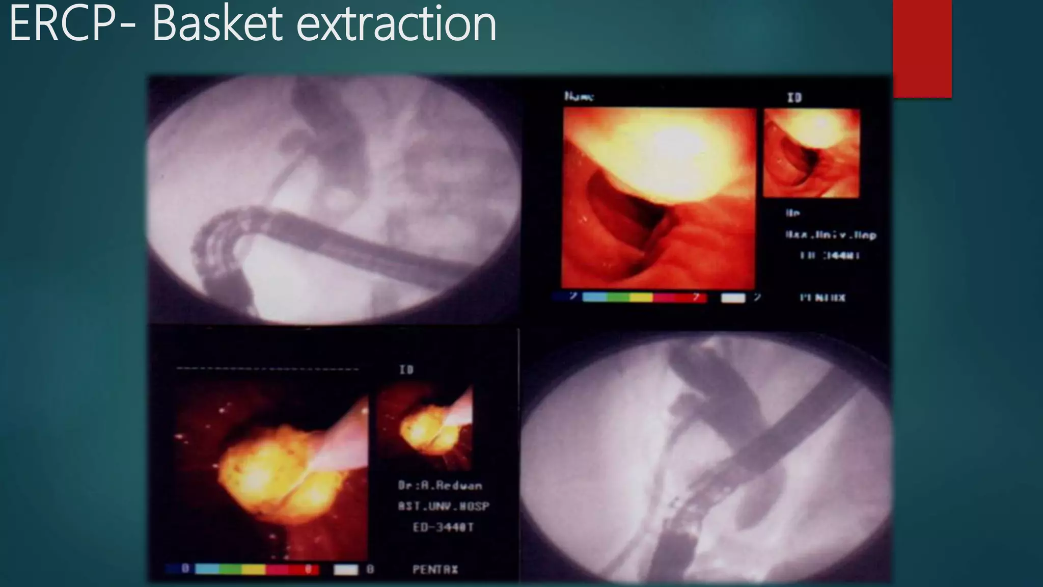 Single stage laparoscopic management for concomitant gallstones and ...