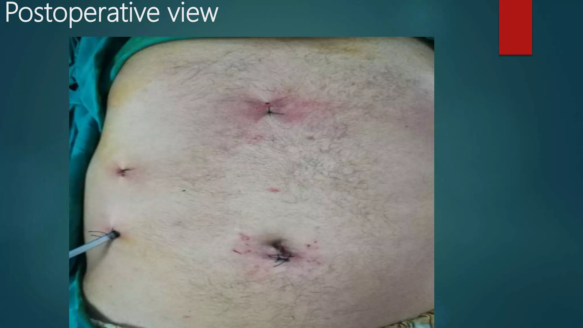 Single stage laparoscopic management for concomitant gallstones and ...