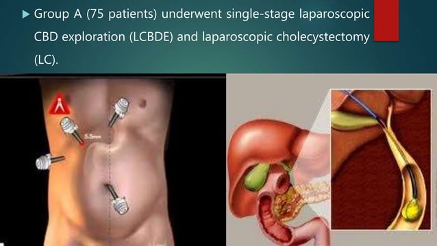 Single stage laparoscopic management for concomitant gallstones and common bile duct stones ...