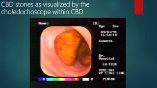 Single stage laparoscopic management for concomitant gallstones and ...