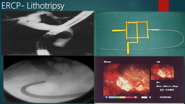Single stage laparoscopic management for concomitant gallstones and common bile duct stones ...