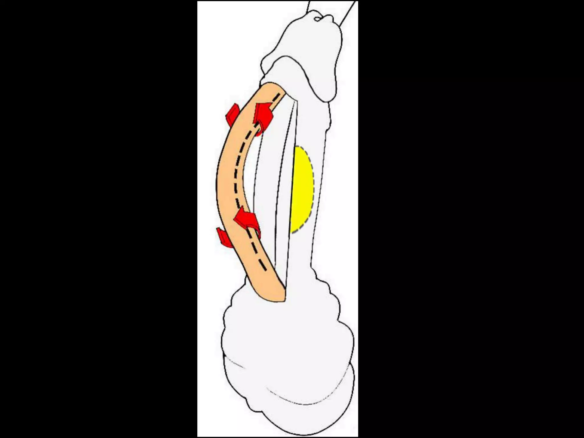 Single stage urethroplasty using penile skin flaps | PDF