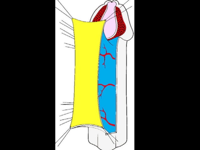Single stage urethroplasty using penile skin flaps | PDF