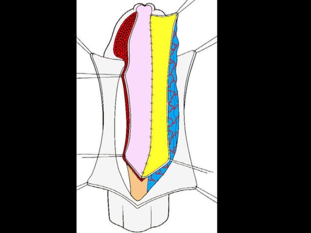 Single stage urethroplasty using penile skin flaps | PDF