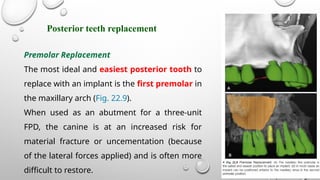Single and Multiple Tooth treatment opionst.pptx