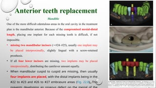 Single and Multiple Tooth treatment options .pptx