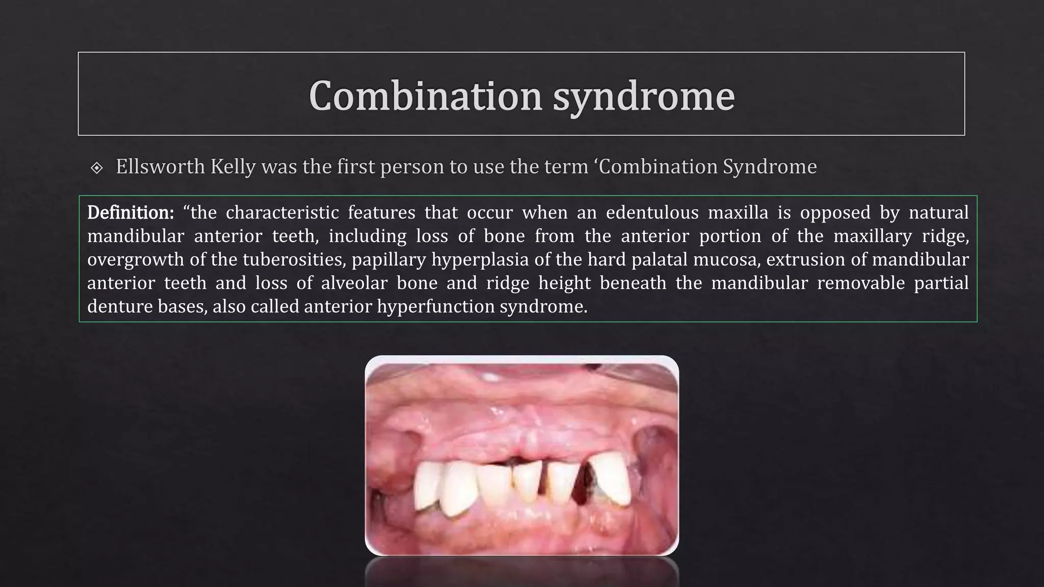Single complete denture | PPTX