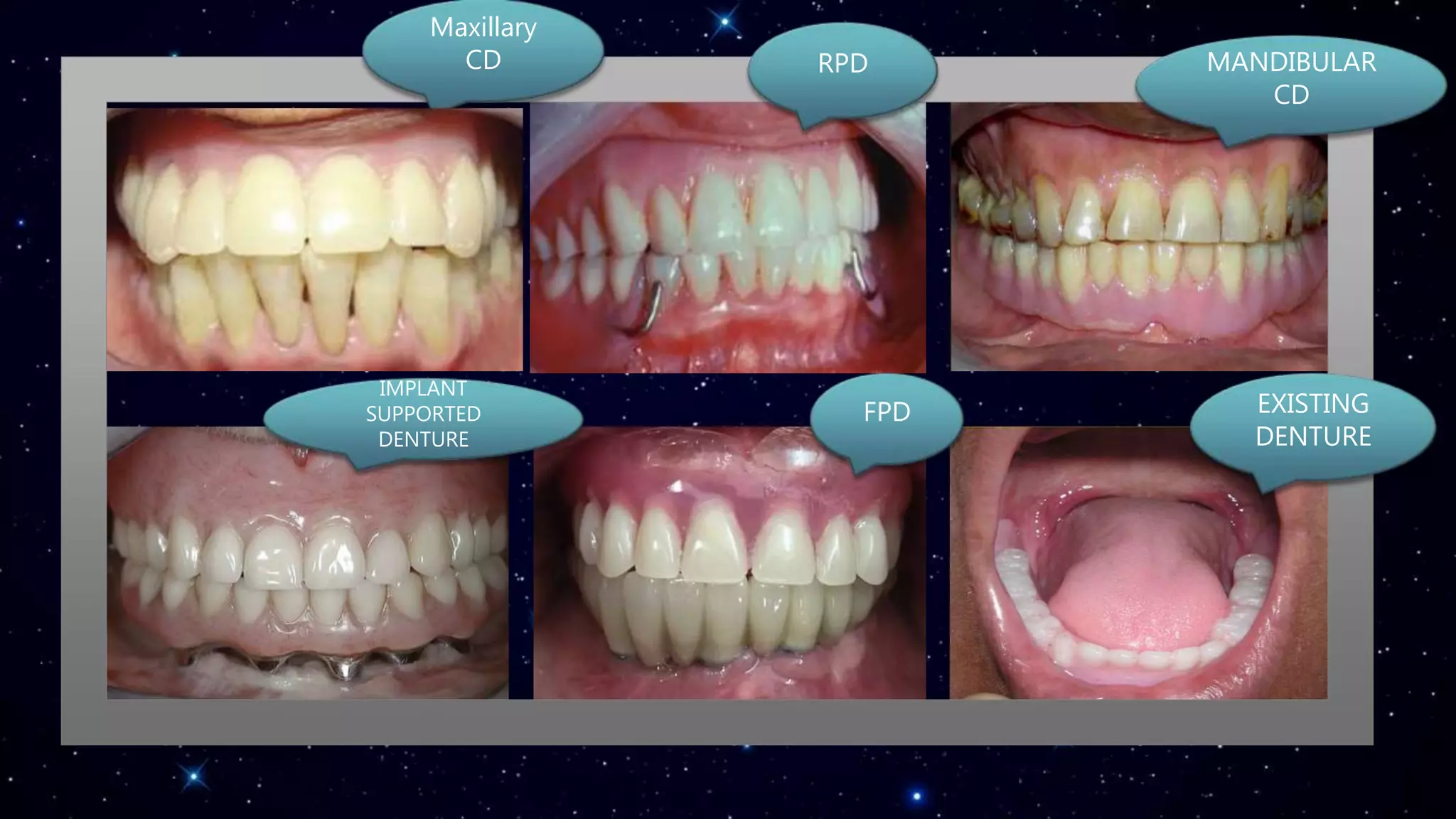 Single complete denture | PPTX