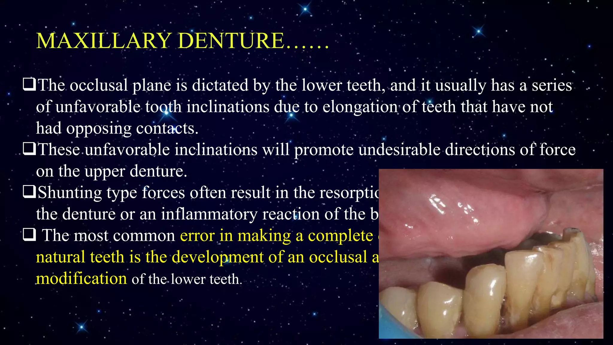 Single complete denture | PPTX