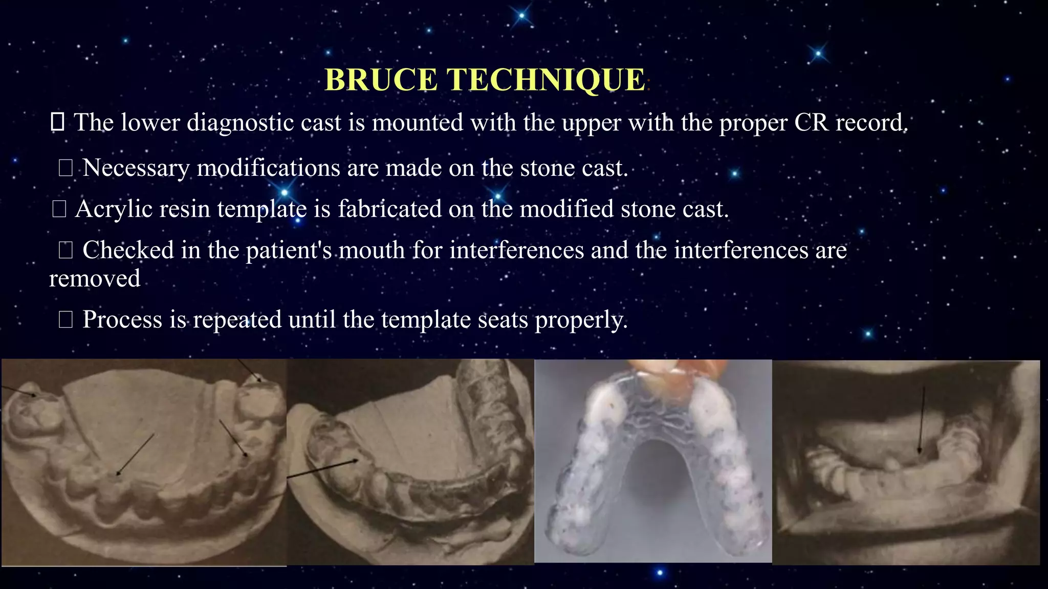 Single complete denture | PPTX