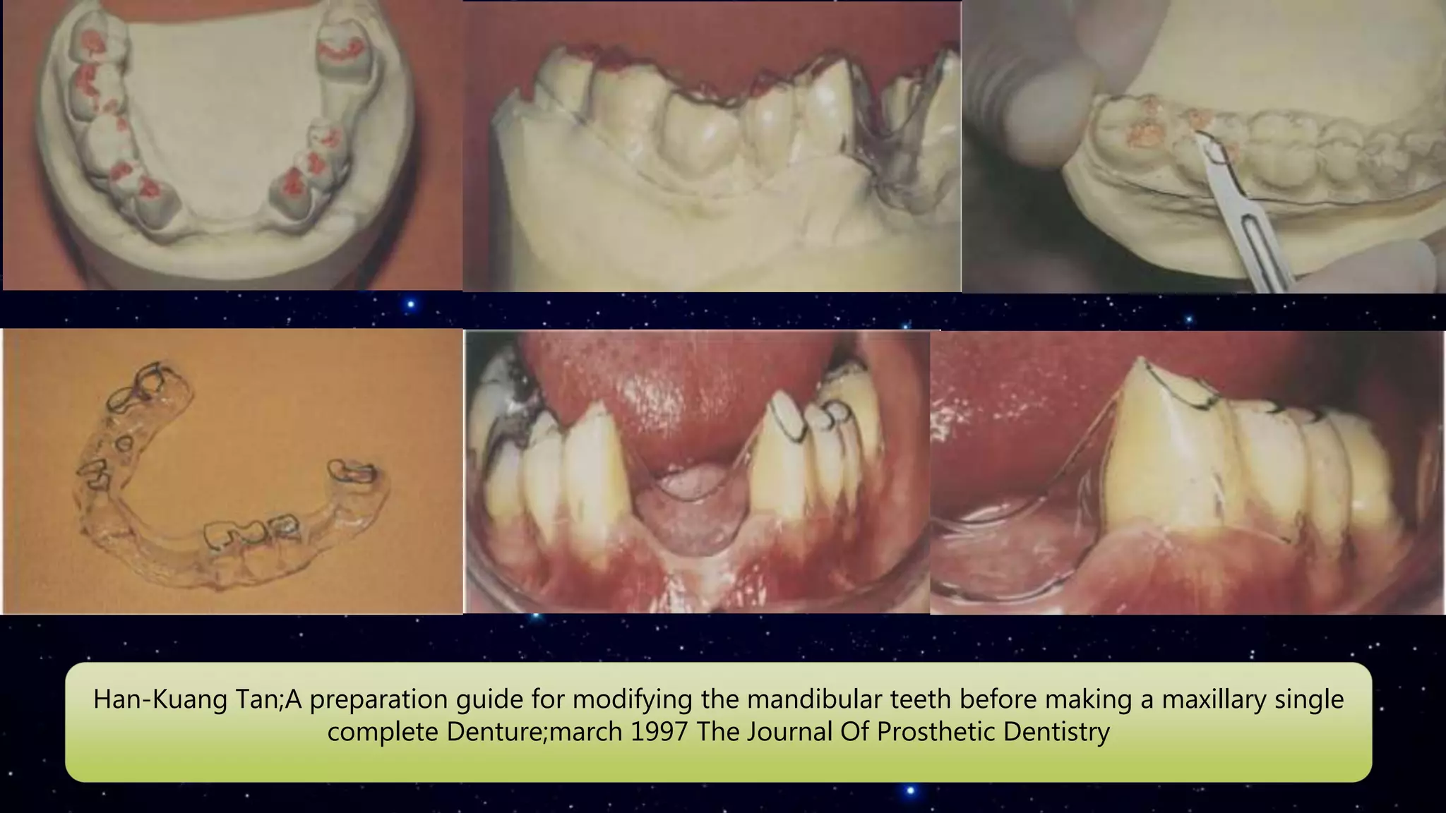 Single complete denture | PPTX