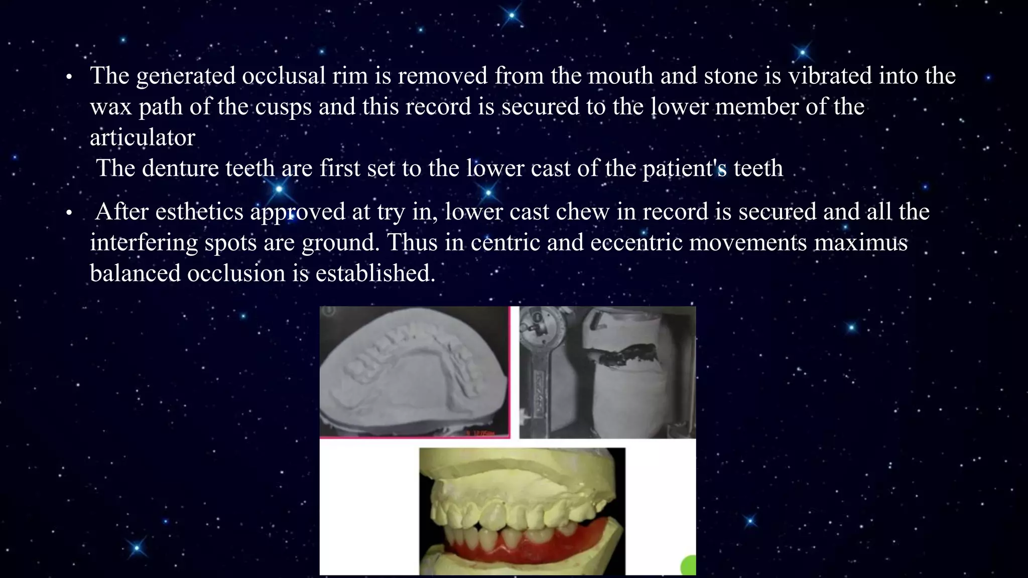 Single complete denture | PPTX