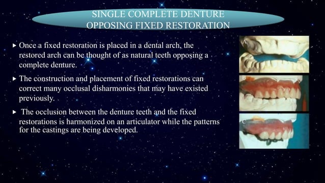 Single complete denture | PPTX