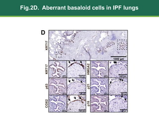 Single-Cell RNAseq in IPF | PPTX