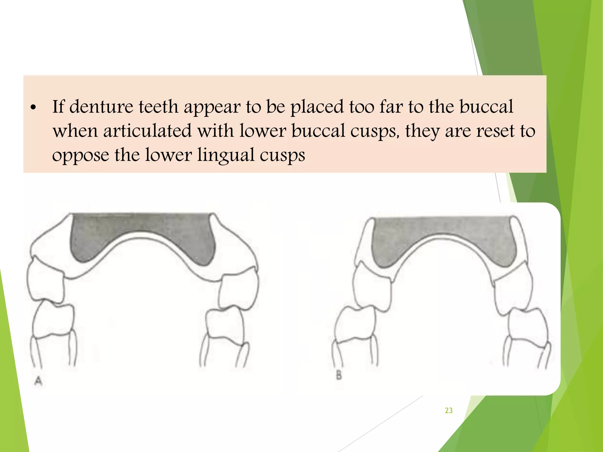 Single complete denture | PPTX