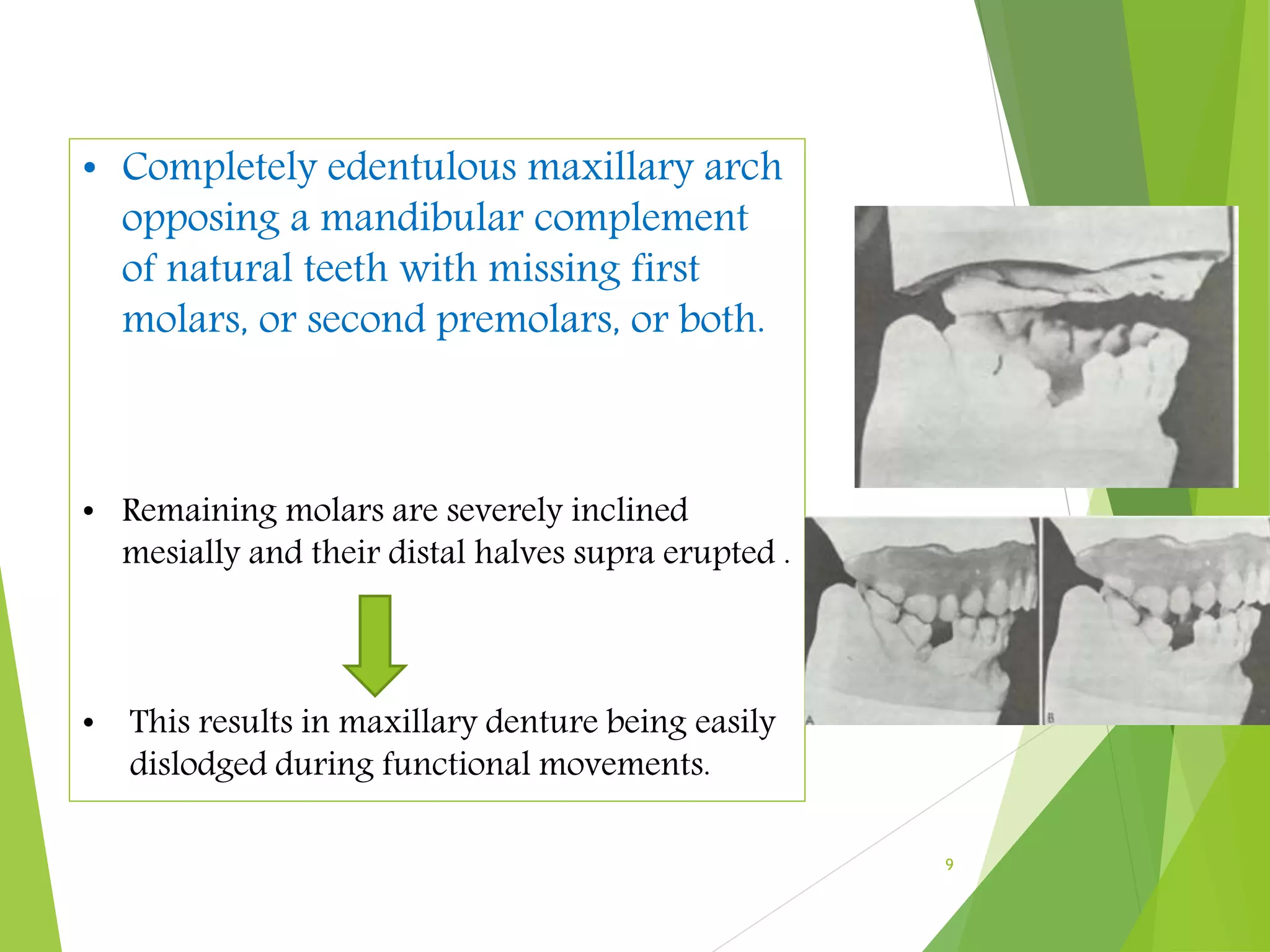 Single complete denture | PPTX