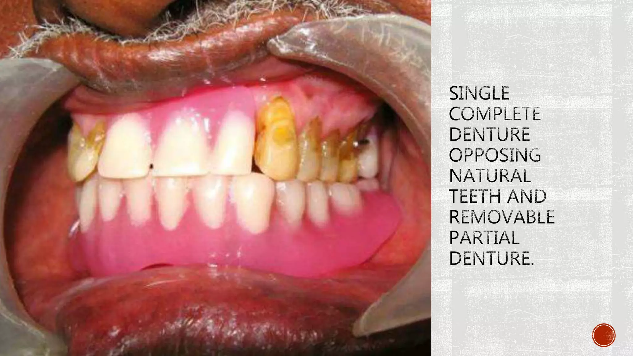 Single complete denture | PPTX