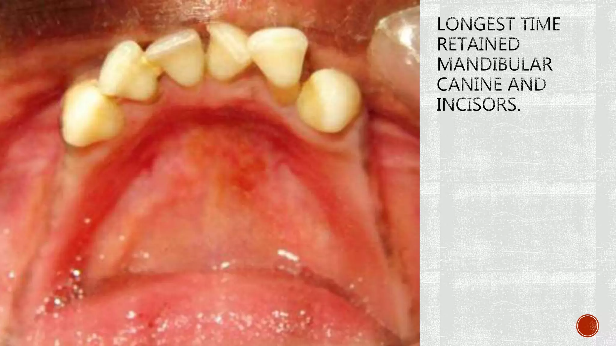 Single complete denture | PPTX