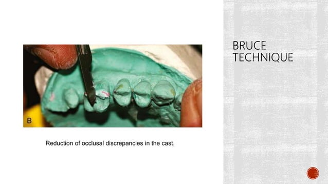 Single complete denture | PPTX | Dental Health | Diseases and Conditions