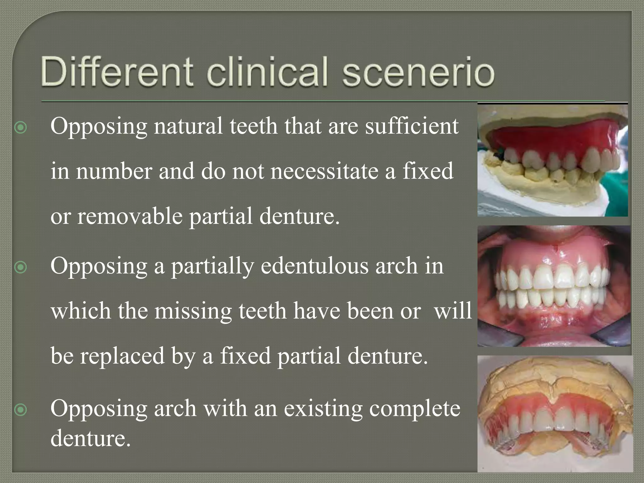 Single complete denture | PPT