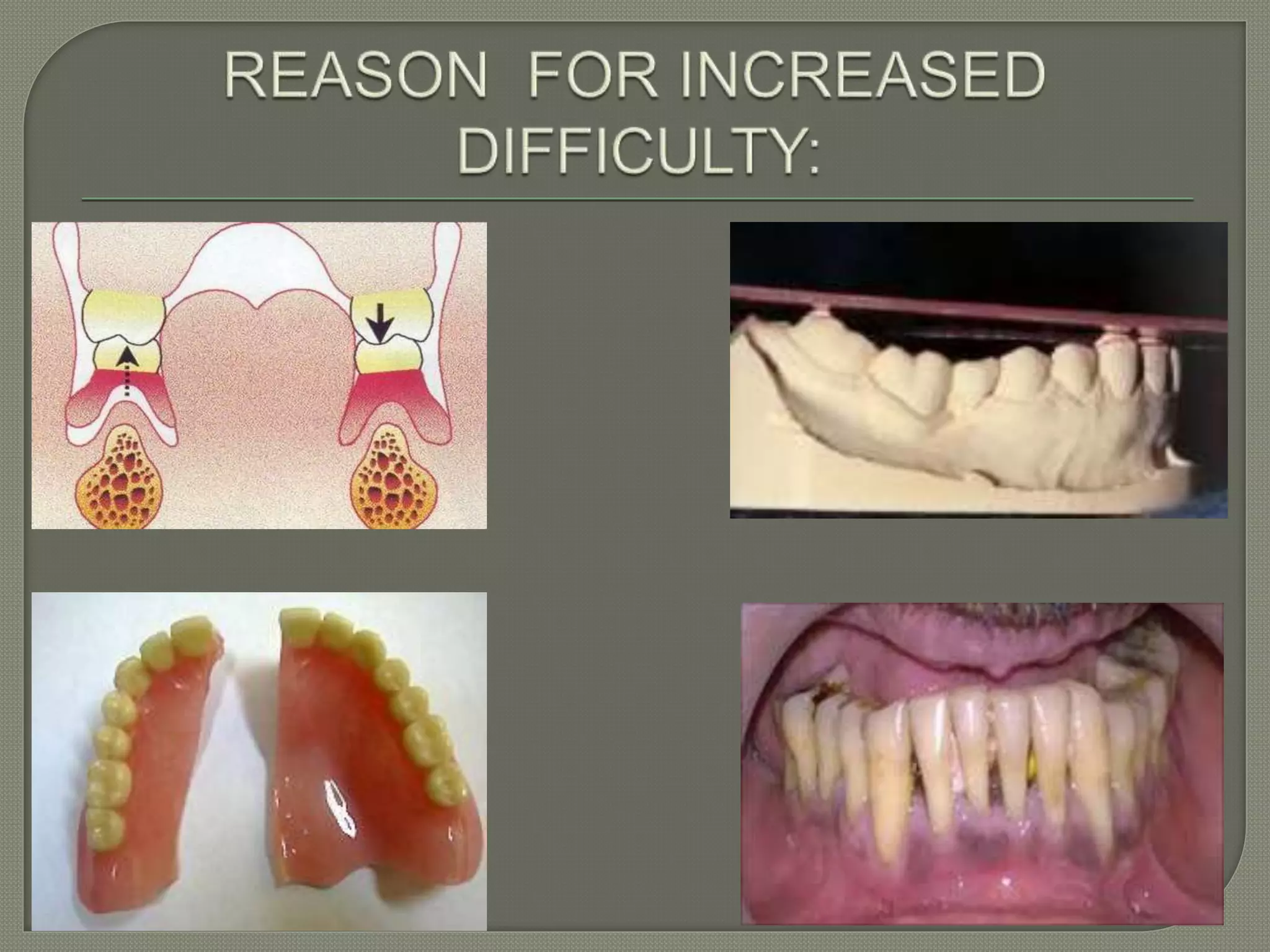 Single complete denture | PPT