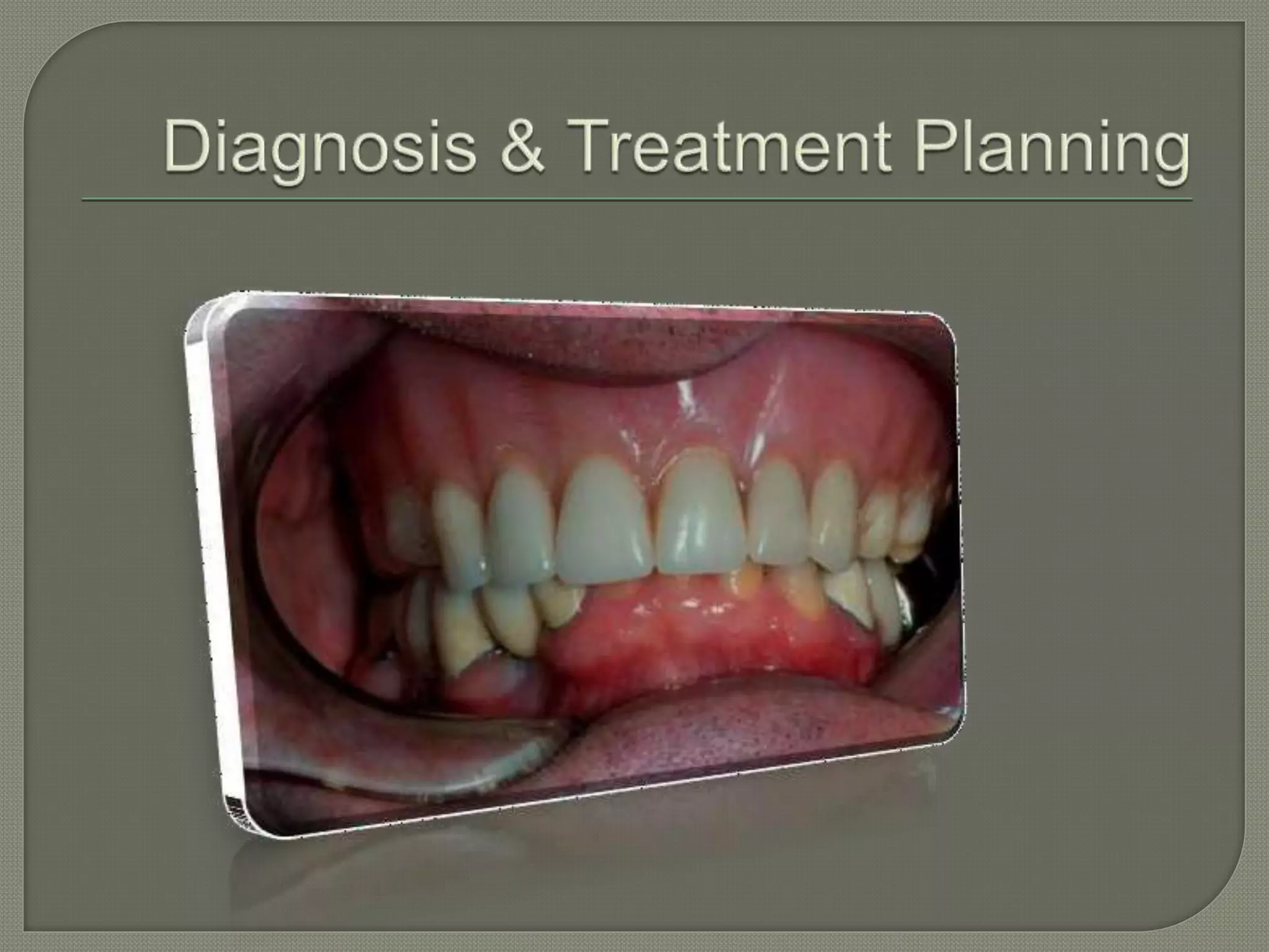 Single complete denture | PPT