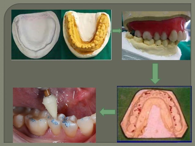 Single complete denture | PPT | Dental Health | Diseases and Conditions
