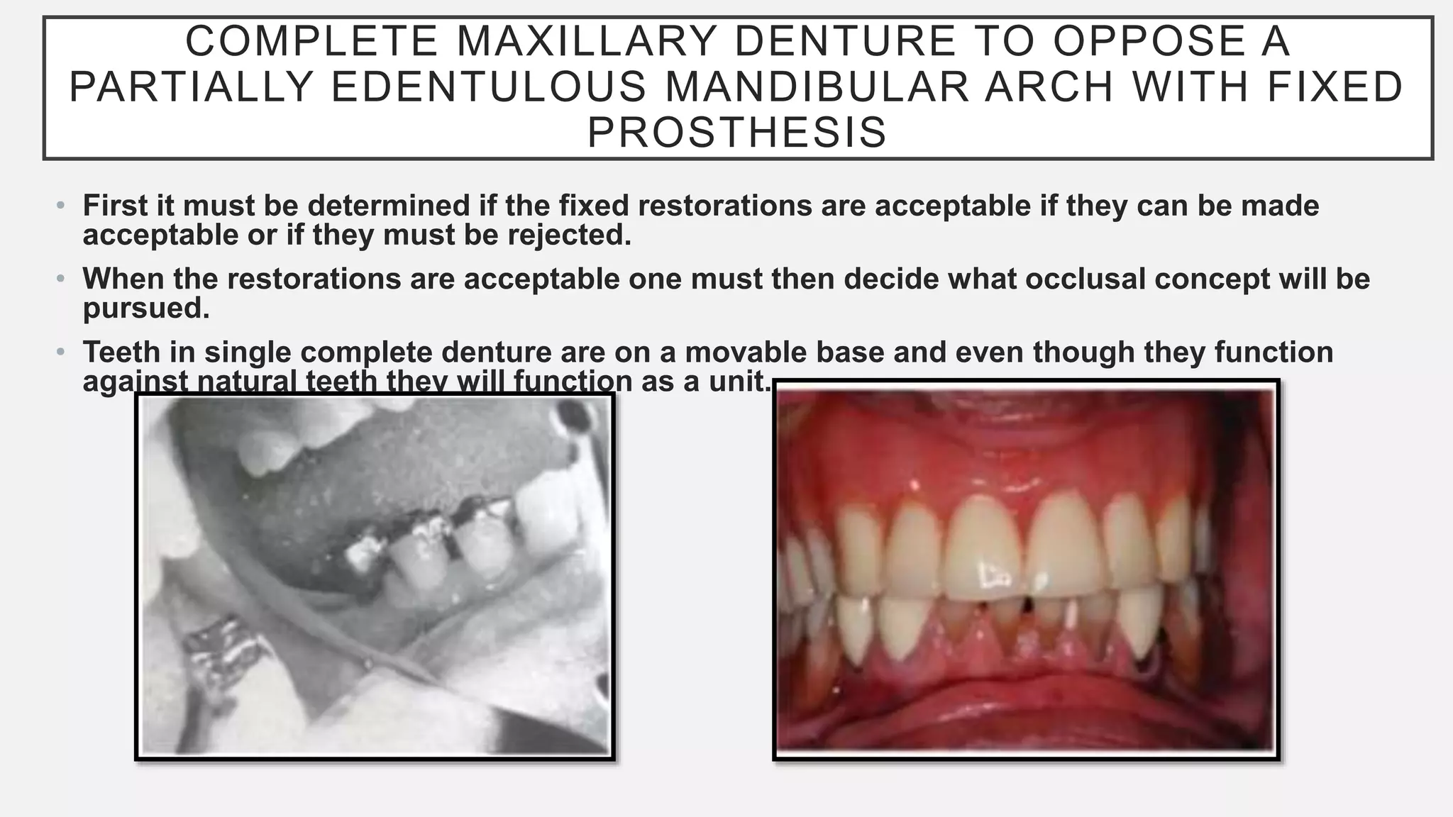 Single complete denture | PPTX