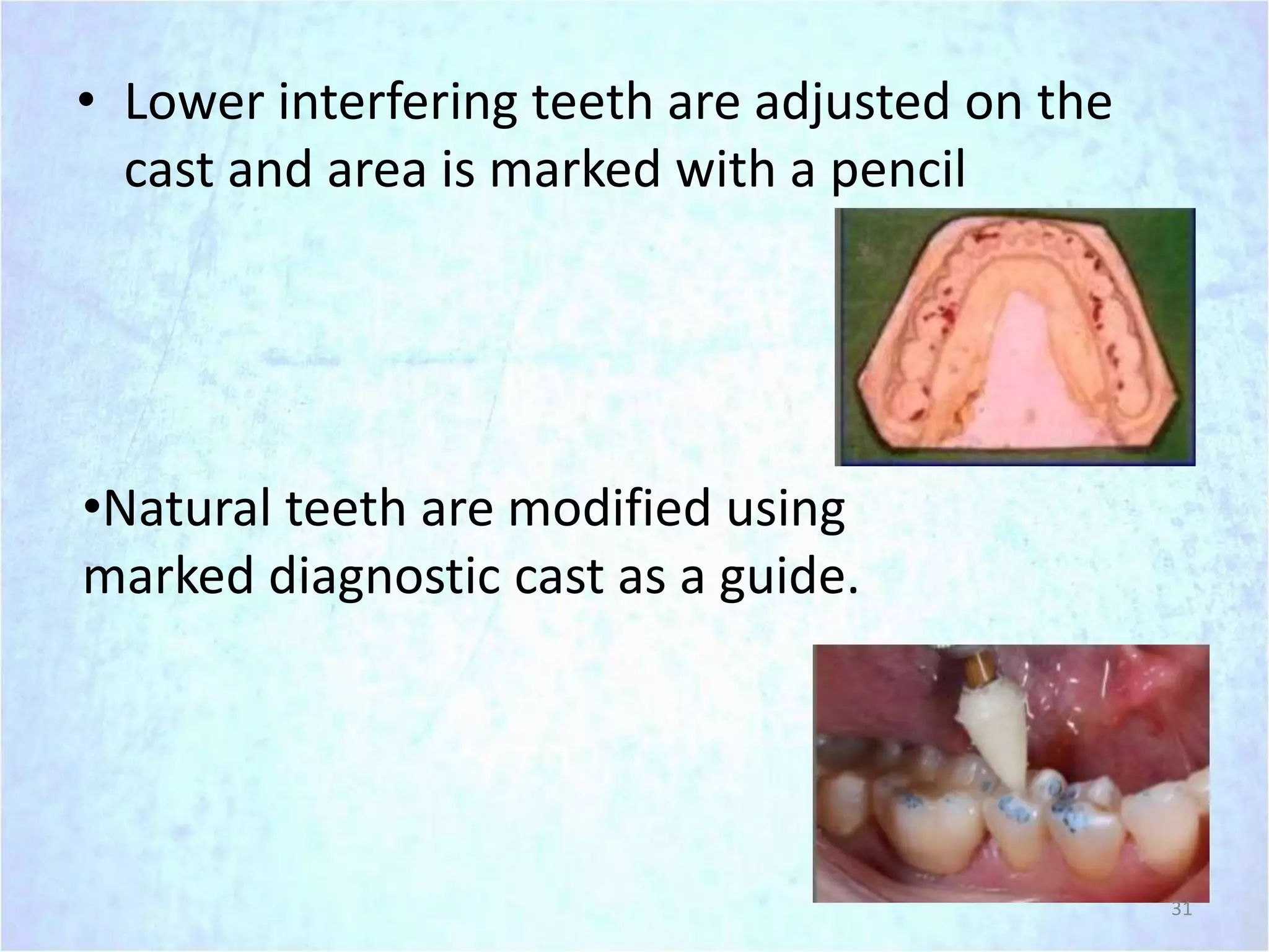Single complete denture | PPTX