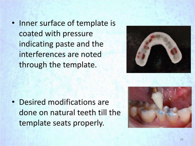 Single complete denture | PPTX