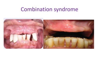 Single_complete_denture prostho1111.pptx