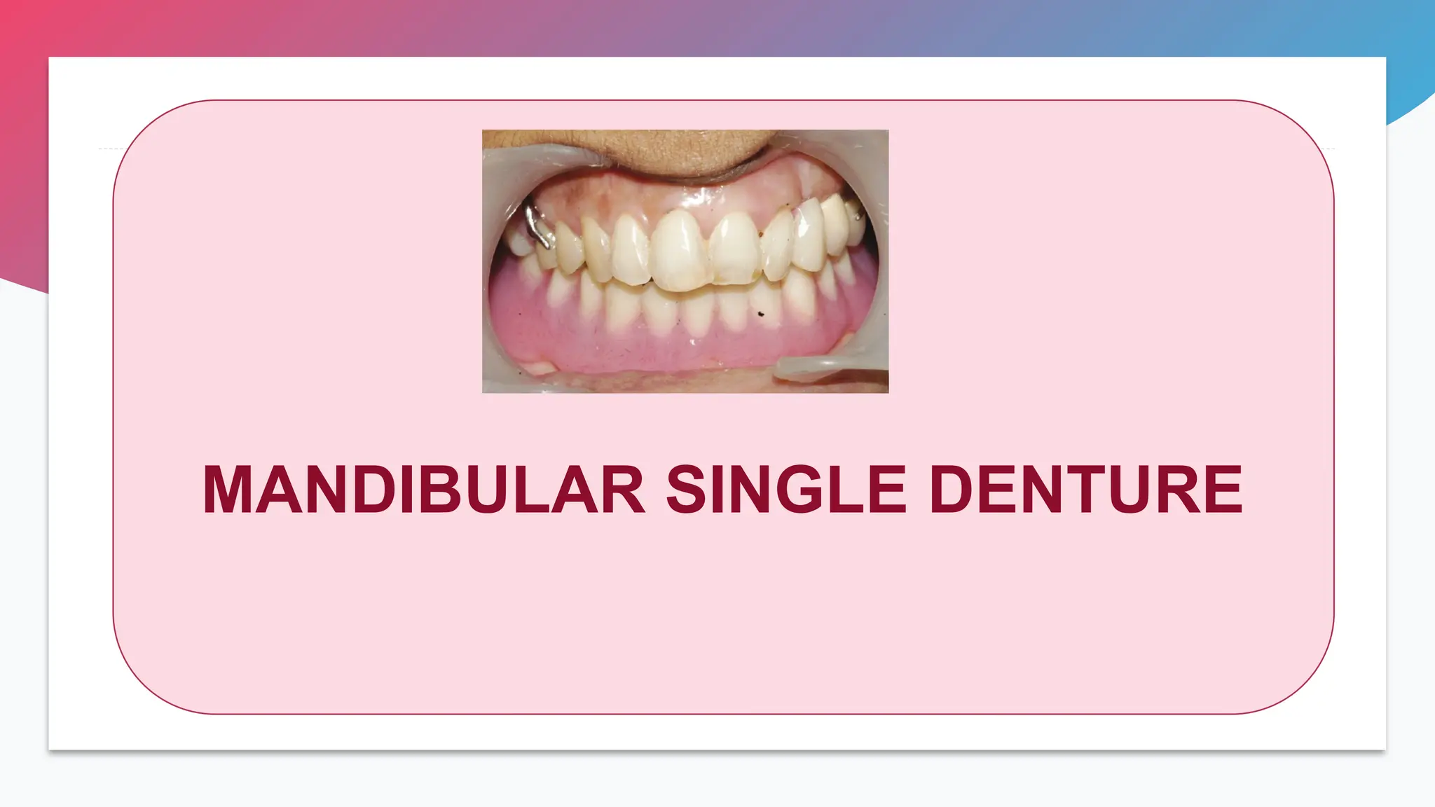 SINGLE COMPLETE DENTURE .pptx