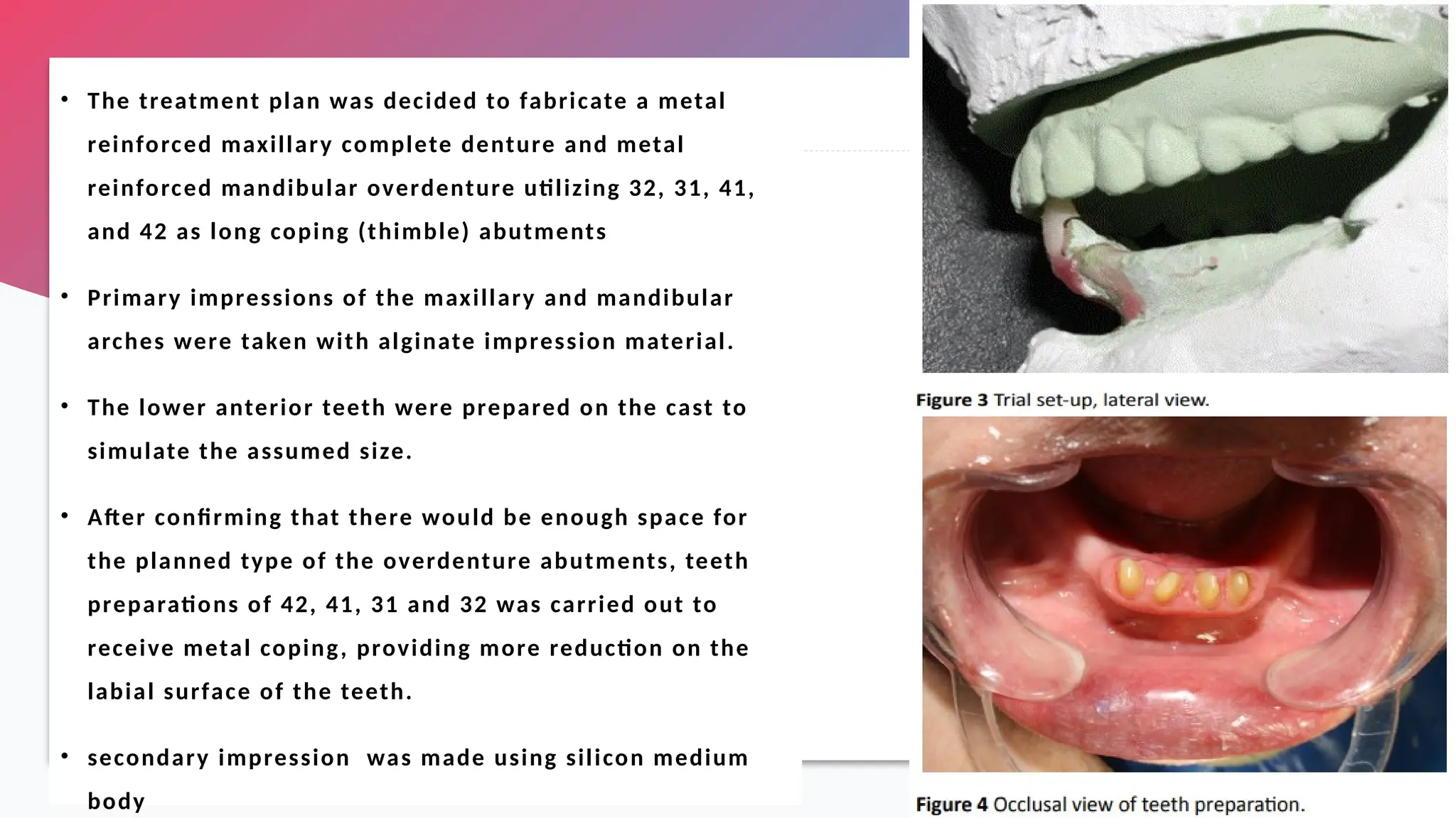 SINGLE COMPLETE DENTURE .pptx
