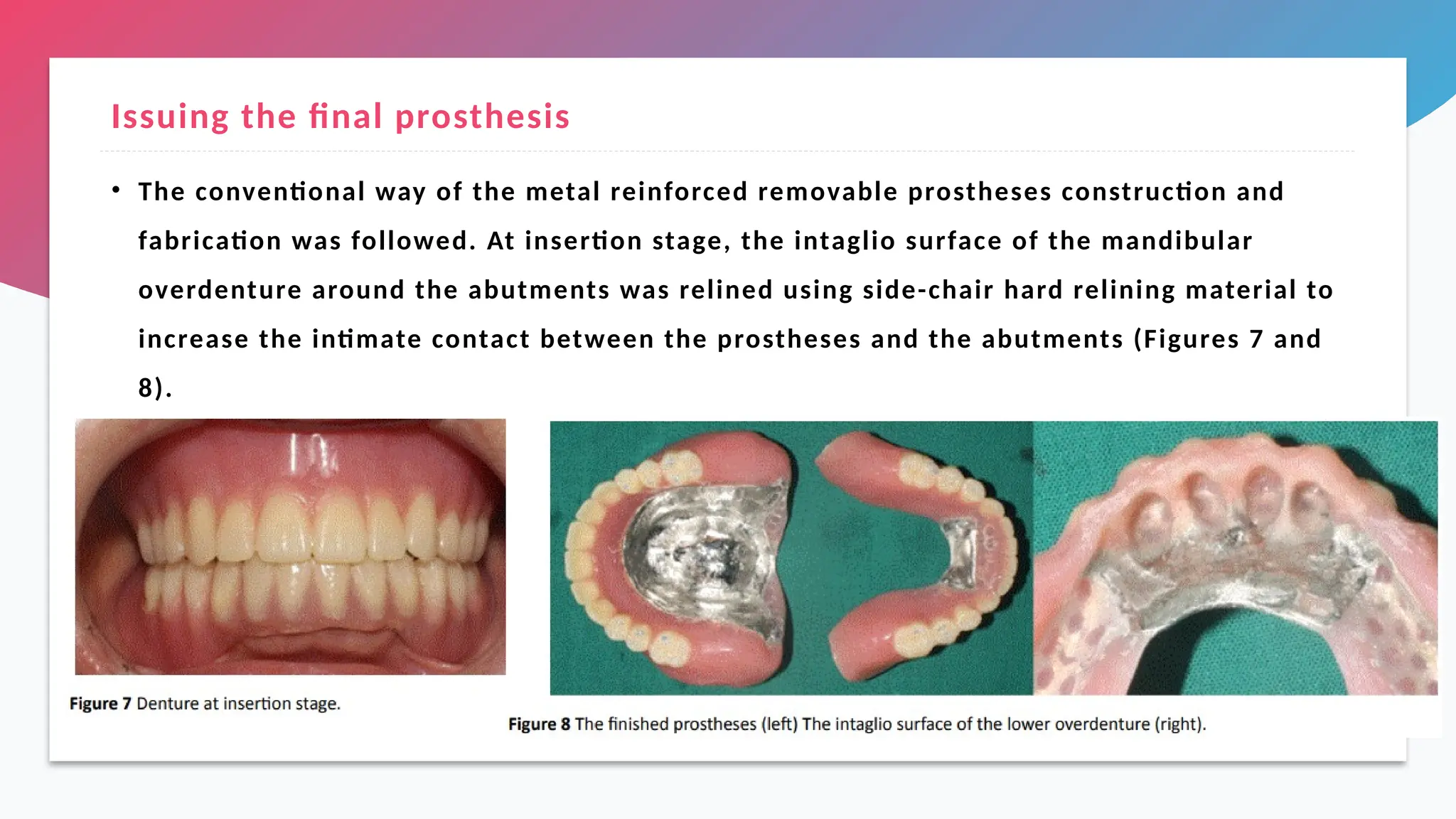SINGLE COMPLETE DENTURE .pptx