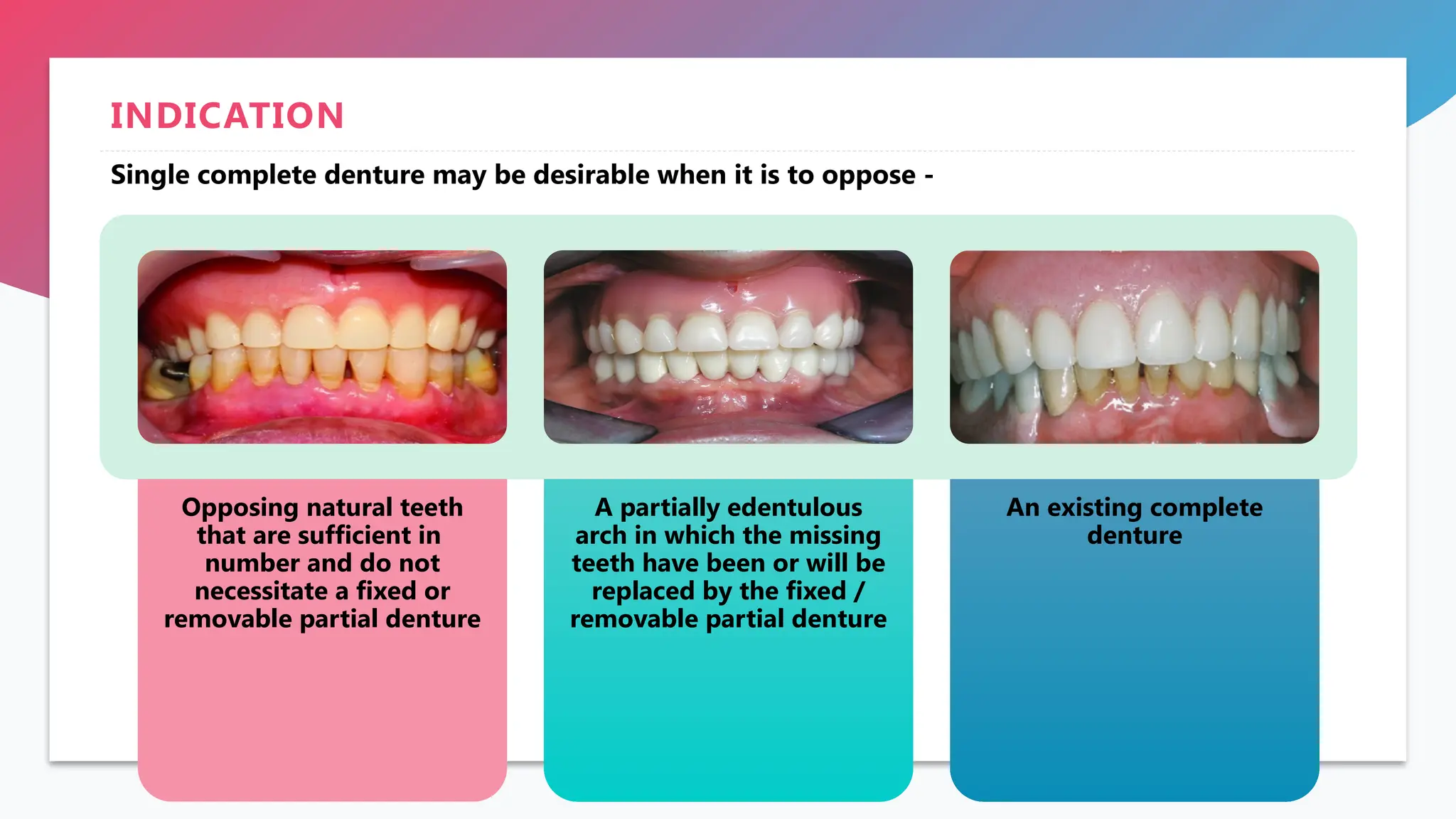 SINGLE COMPLETE DENTURE .pptx