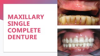 SINGLE COMPLETE DENTURE .pptx